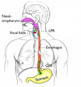 Voice Problems and Acid Reflux – Singing from the Inside Out